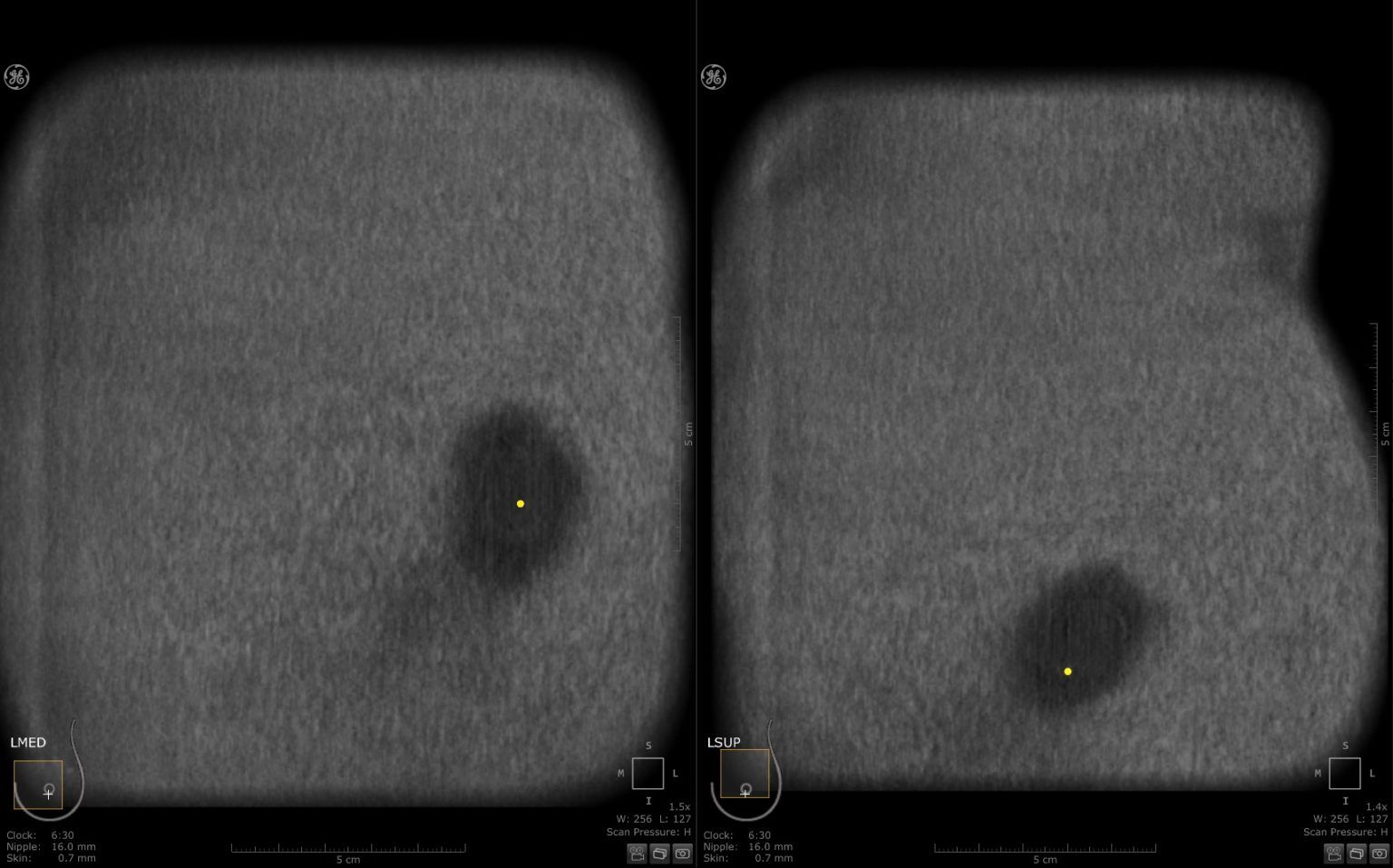 3-D Automated Breast Ultrasound (ABUS) - Διαγνωστική Μαστογραφία